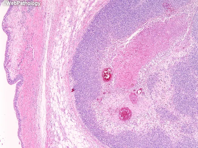 Primitive Neuroectodermal Tumor