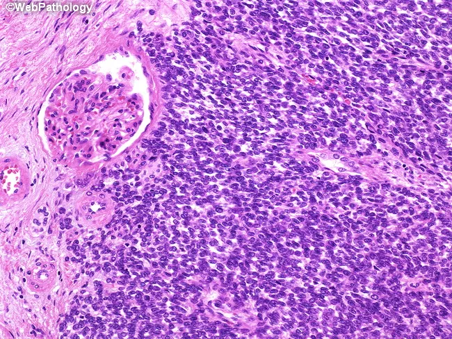 Primitive Neuroectodermal Tumor