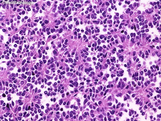 Primitive Neuroectodermal Tumor