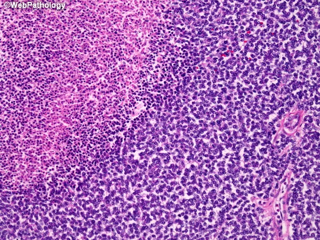 Primitive Neuroectodermal Tumor