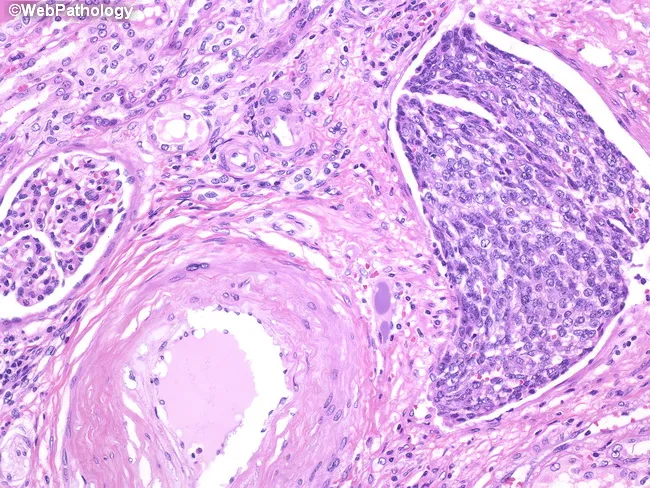 Primitive Neuroectodermal Tumor