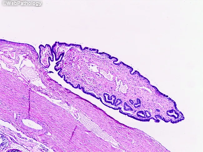 Appendix testis