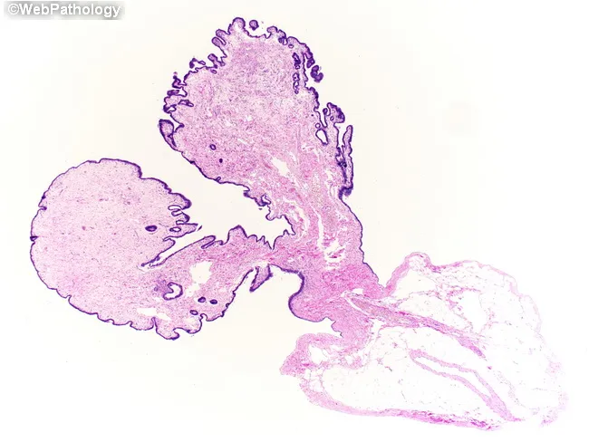 Appendix Testis