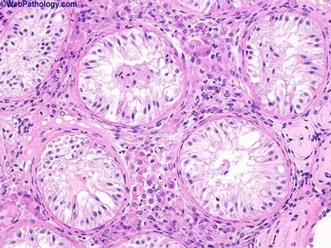 Sertoli-cell-only Syndrome (Germ Cell Aplasia)