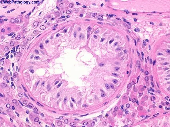 Sertoli-cell-only Syndrome (Germ Cell Aplasia)