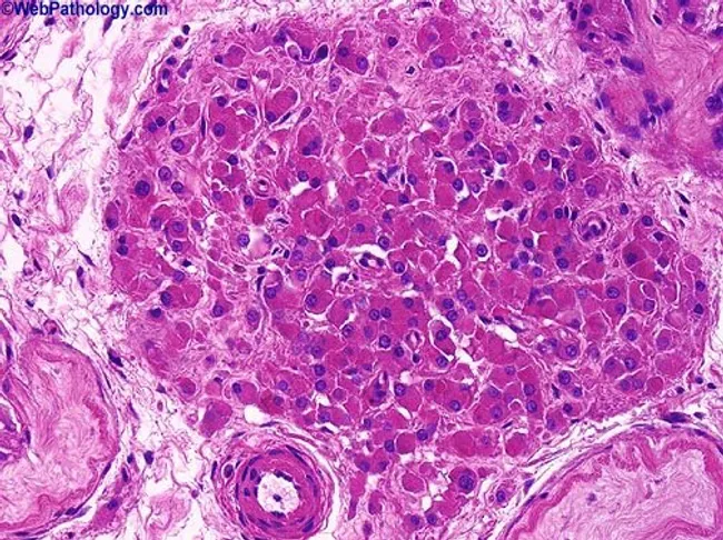 Testes : Klinefelter's Syndrome (47 XXY)