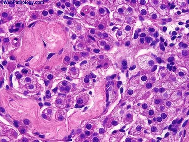 Testes : Klinefelter's Syndrome (47XXY)