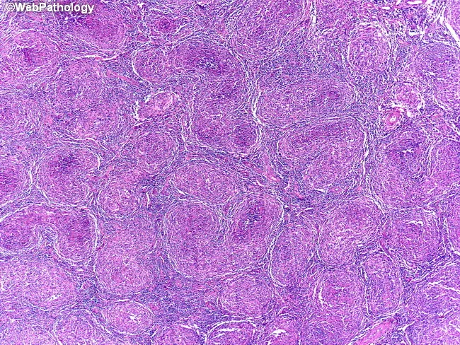 Idiopathic Granulomatous Orchitis