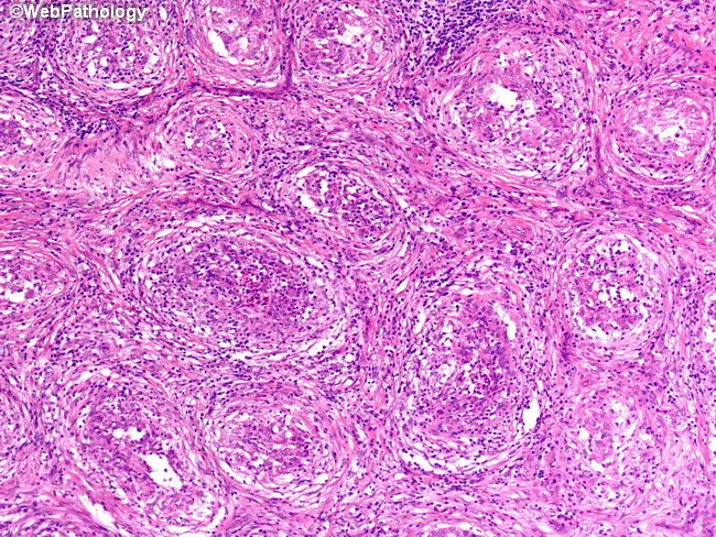 Idiopathic Granulomatous Orchitis