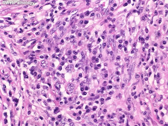 Idiopathic Granulomatous Orchitis