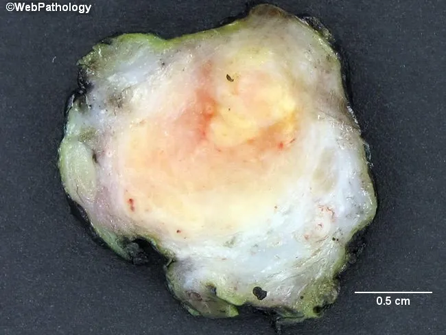 Tuberculous Epididymo-orchitis