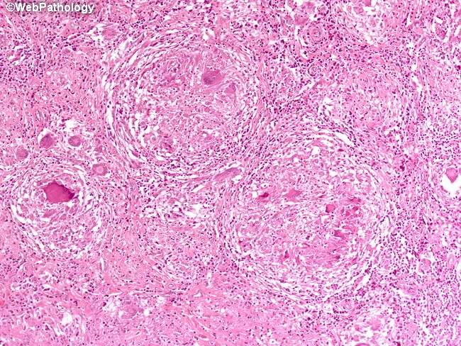 Tuberculous Epididymo-orchitis