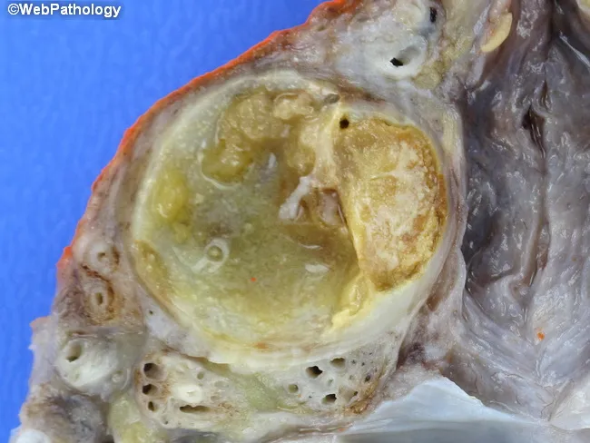 Xanthogranulomatous Epididymo-orchitis