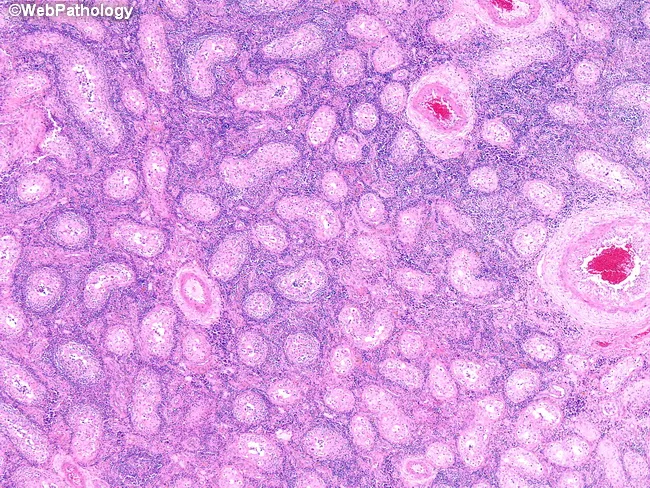 Acute Epididymo-orchitis