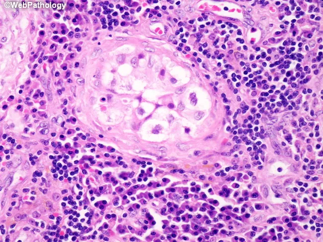 Acute Epididymo-orchitis