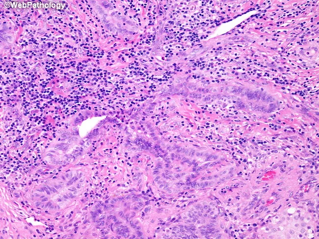Acute Epididymo-orchitis
