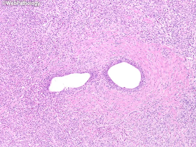 Acute Epididymo-orchitis