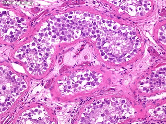 Germ Cell Neoplasia in situ