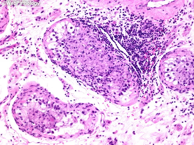 GCNIS: Granulomatous inflammation