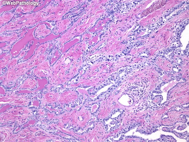 GCNIS : Pagetoid Spread to Rete Testis