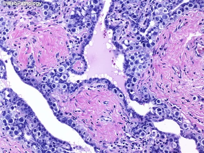 GCNIS : Pagetoid Spread to Rete Testis