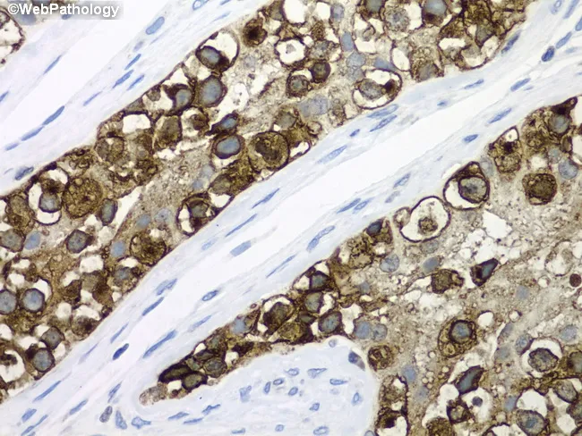 Germ Cell Neoplasia in situ : PLAP