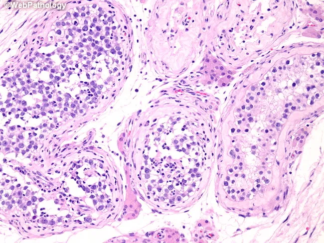 Intratubular Seminoma