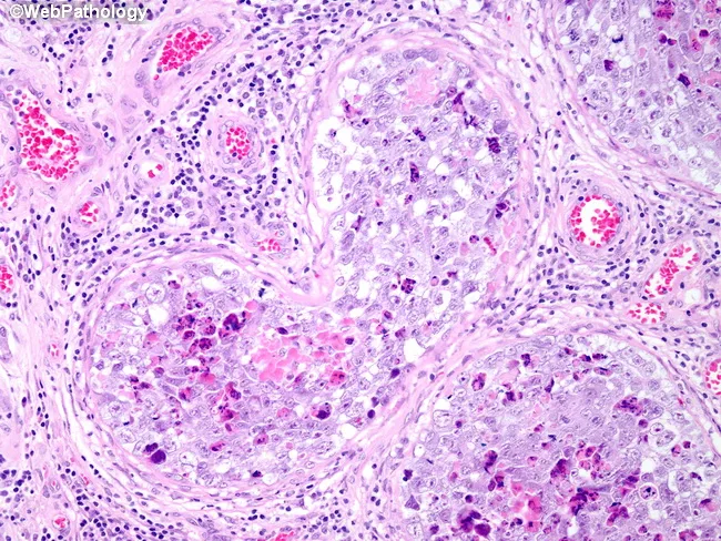 Intratubular Embryonal Carcinoma