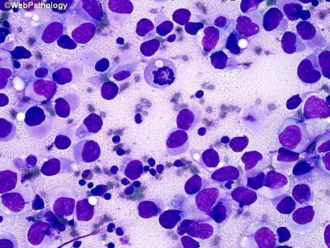 Seminoma : Touch Prep