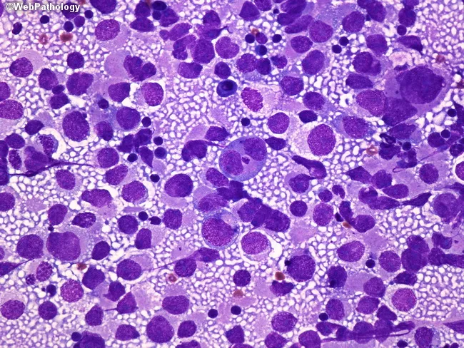 Seminoma : Touch Prep