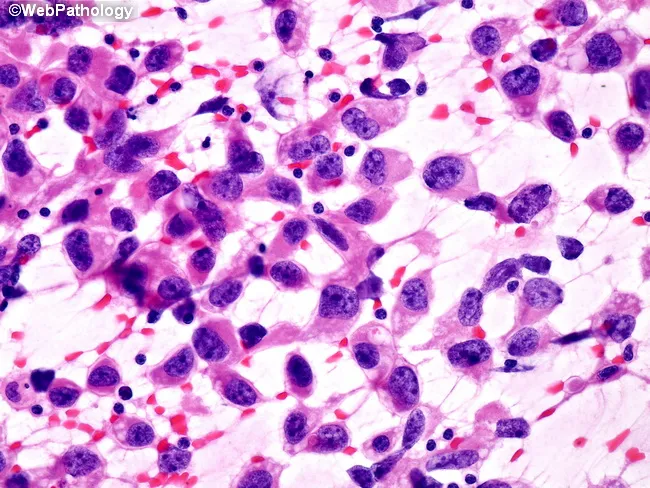 Seminoma : Touch Prep