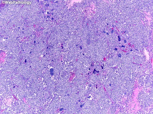 Seminoma : Syncytiotrophoblastic Cells