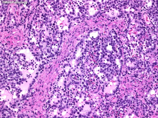 Seminoma : Pseudoglandular Pattern