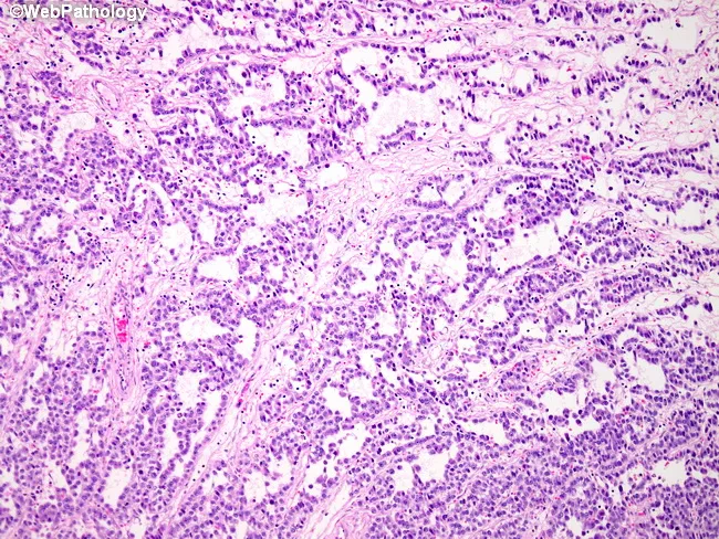 Seminoma : Pseudoglandular Pattern