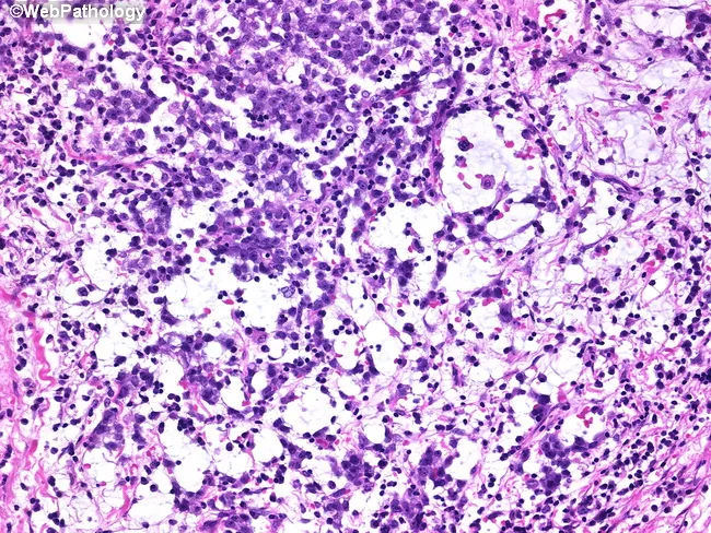 Seminoma : Microcystic Pattern