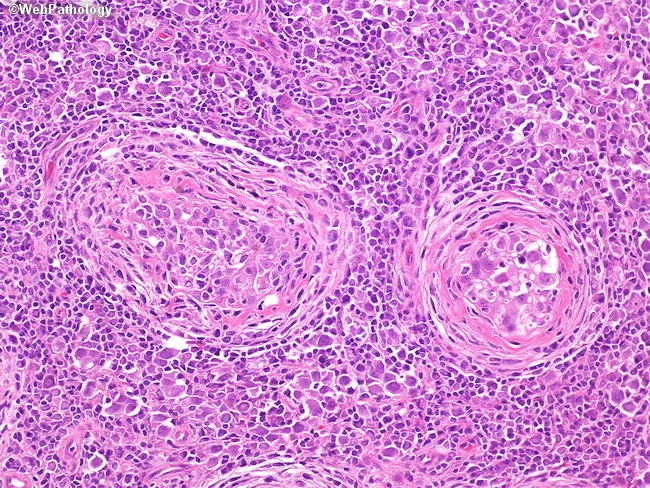 Seminoma : Interstitial Pattern