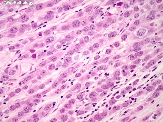 Seminoma : Cording Pattern