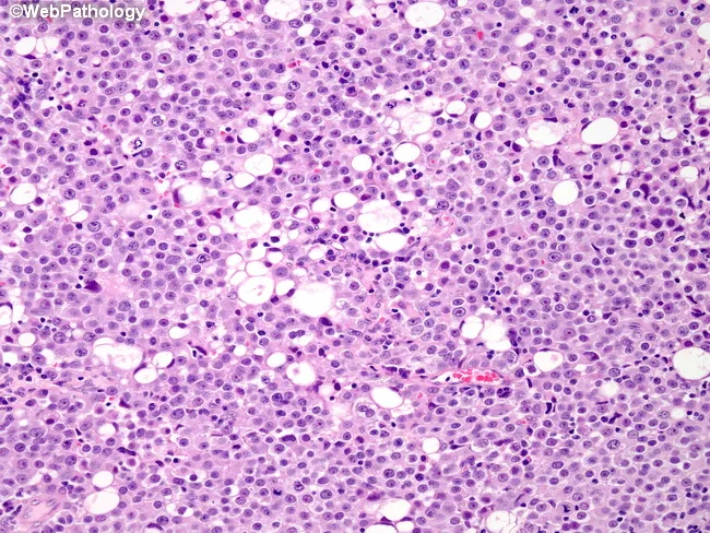 Seminoma : Signet Ring Cells