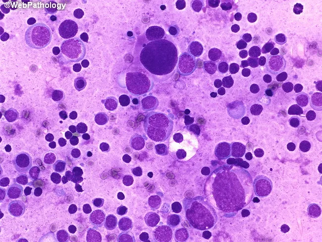 Spermatocytic Tumor : Touch Prep