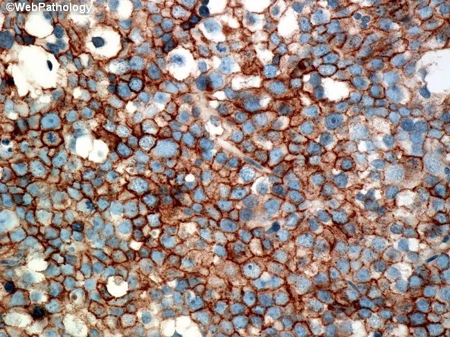 Spermatocytic Tumor : CD117 (c-kit)
