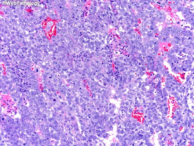 Embryonal CA : Solid pattern
