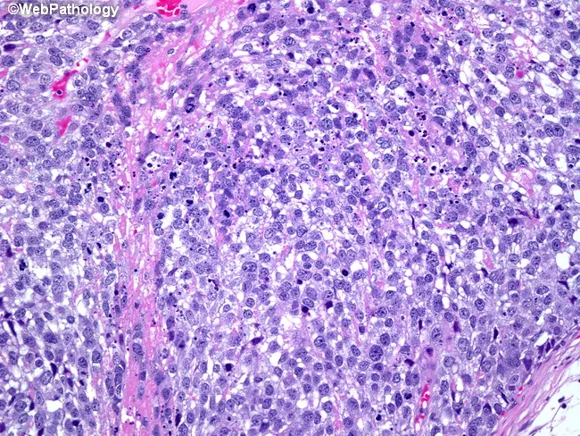 Embryonal CA : Solid pattern vs Seminoma