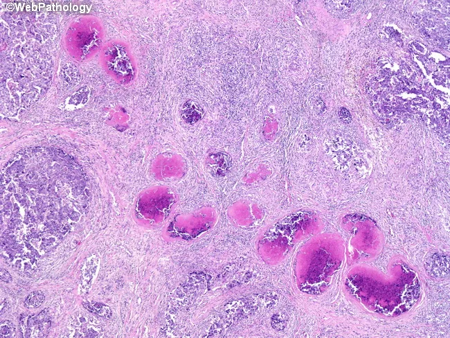 Embryonal CA: Intratubular