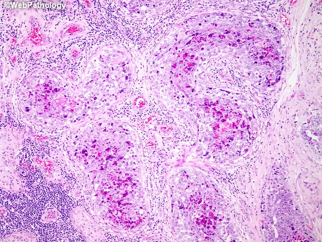 Embryonal CA : Intratubular