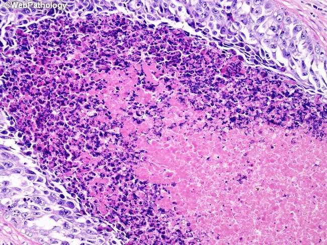 Embryonal CA : Necrosis