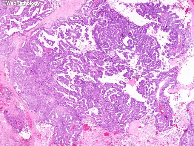 Embryonal CA : Papillary pattern