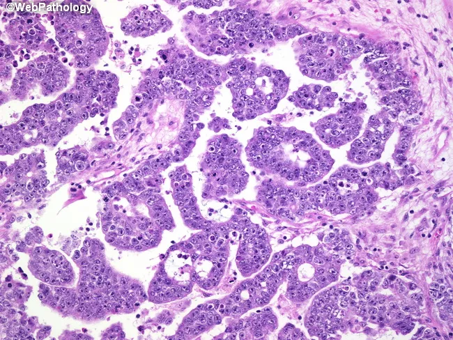 Embryonal CA : Papillary pattern