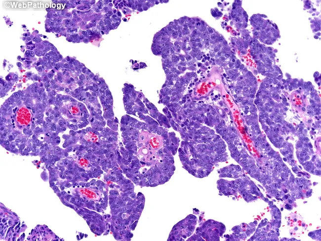 Embryonal CA : Papillary