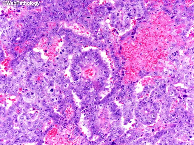 Embryonal CA : Papillary pattern