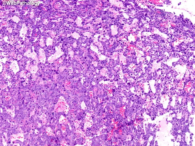 Embryonal CA : Sieve-like pattern